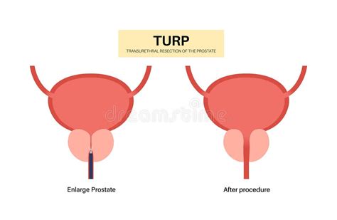 Transurethral Resection Of The Prostate Stock Vector Illustration Of