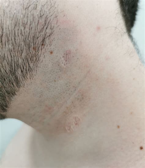 Clinical Manifestations Of Jadassohn Anetoderma In Patient E 34 Years Download Scientific