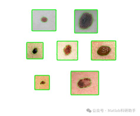 【图像分割】基于pca 和迭代 Canny Edge皮肤病变分割算法研究附matlab代码皮肤病变图像分割系统的设计和实现 Csdn博客