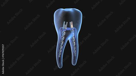 Dental Steel Post Inside Molar Teeth Xray View Dental Endodontic