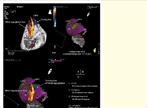 Mitral Regurgitation Flow Hitting The Left Atrial Wall In The Localized Download Scientific