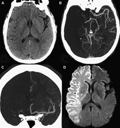 Clinical Applications Of Diffusion MR Imaging For Acute Ischemic Stroke Radiology Key
