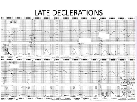 Fht Interpretation And Management
