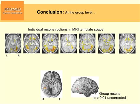 Ppt Eeg Meg Source Localisation Powerpoint Presentation Free