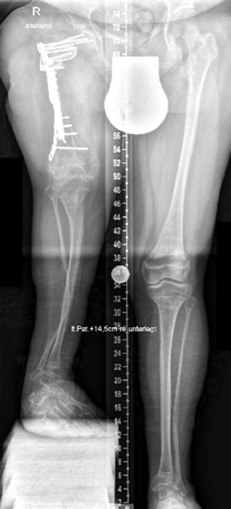 High Resolution Peripheral Quantitative Computed Tomography Scans Of Download Scientific