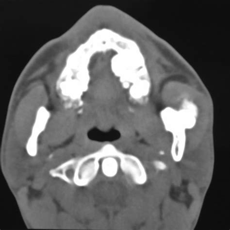 Multiple Polyps Of The Intestine Revealed By Colonoscopy Download Scientific Diagram