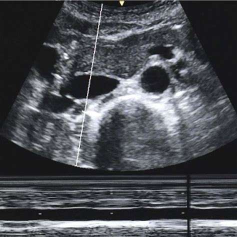 Subxiphoidal Short Axis Access Of The Major Vessels For IVC Depicted Download Scientific