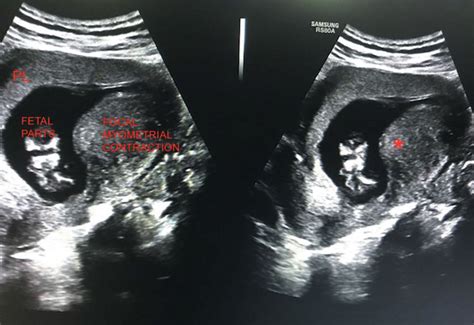 Incompetent Cervix Ultrasound