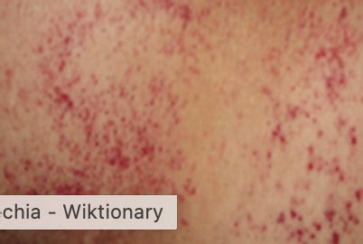 BLEEDING DISORDERS Found Set Flashcards Quizlet