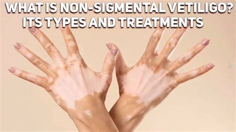 What Is Non Segmental Vitiligo Vitiligo Symptoms And Treatments Youtube