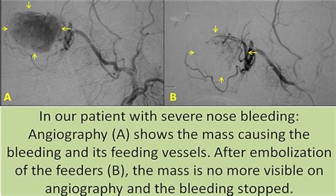 Chemoembolization Tace In Cancer