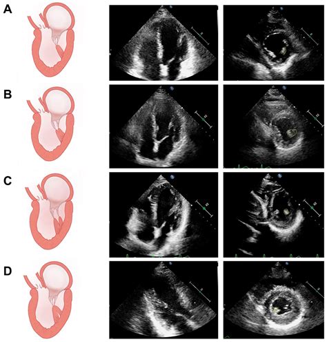 Left Ventricular Papillary Muscle Anatomy Pathophysiology And