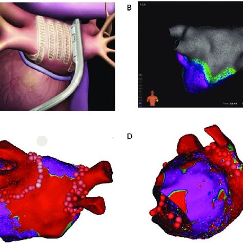 Convergent Procedure Complications Download Scientific Diagram