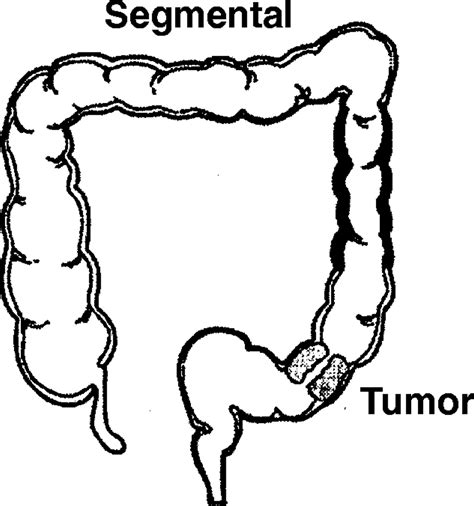 Proximal Vs Distal Colon