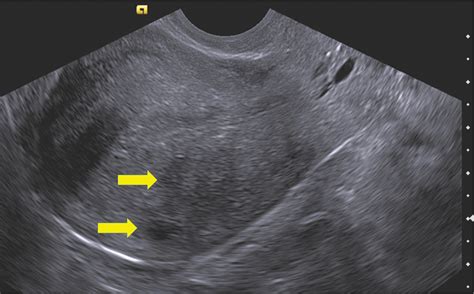 Nodular Adenomyosis Of The Fallopian Tube Journal Of Gynecologic Surgery