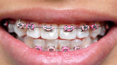 A Brief History Of Braces Mental Floss