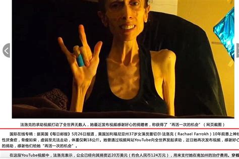 美国女演员募集124万治疗神经性厌食症 体重仅18kg 美国女演员募集124万治疗神经性厌食症 体重仅18kg