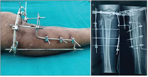 EXTERNAL FIXATOR LithosMed