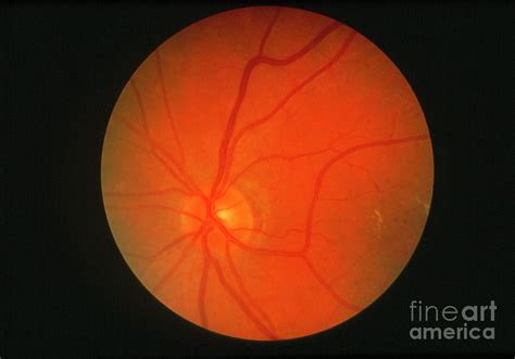 Fundus Camera Image Of Mild Diabetic Retinopathy Photograph By Science