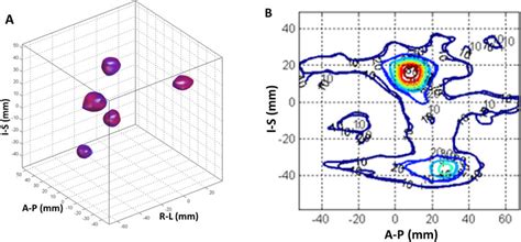 3d Gel Dosimetry Example Showing Good Agreement Between Tps Calculation