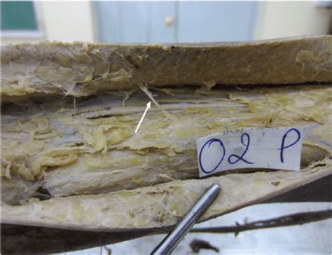 Skin Perforating Branch Download Scientific Diagram