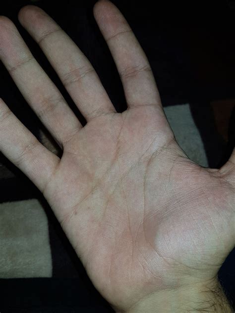 Красные точки на ступнях и ладонях Около месяца назад появились красные Medaboutme