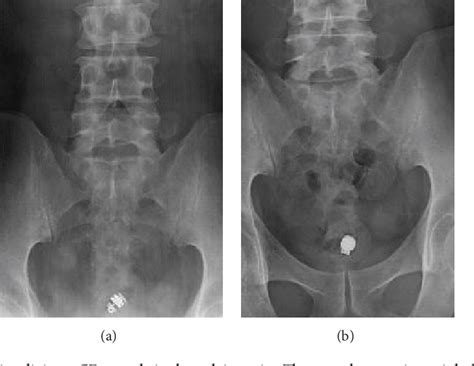 Video Capsule Endoscopy X Ray At Christy Thrower Blog