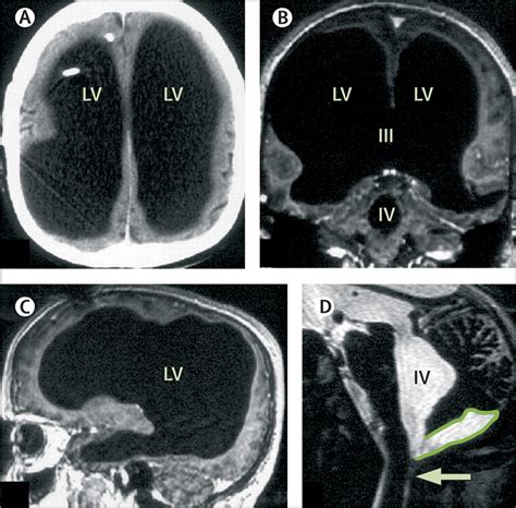 Meet The Healthy Functioning Man Who Survived With Almost No Brain