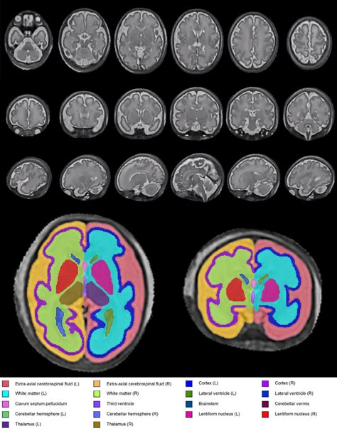 Example 3d Slice To Volume Reconstructions Of T2 Weighted Fetal Brain