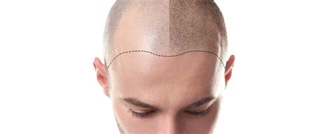Micro Scalp Pigmentation Cosmetic Hair Loss Solution Invisi Hair Uk