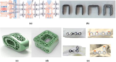 Research Progress Of Metal Based Additive Manufacturing In Medical Implants