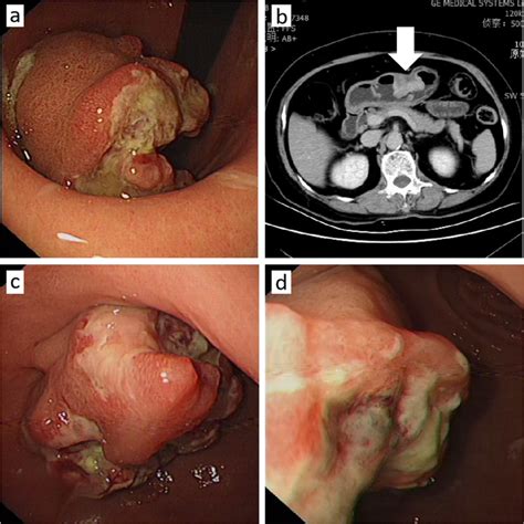 Endoscopy And Computed Tomography Ct Findings A Endoscopy At The Download Scientific Diagram
