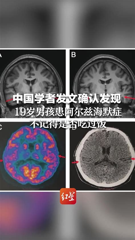 中国学者发文确认 发现19岁男孩患阿尔兹海默症，不记得是否吃过饭凤凰网视频凤凰网