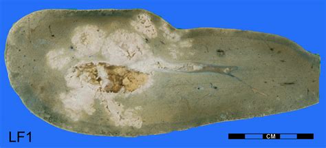 Hepatic Amoebic Abscesses Museum Of Pathology