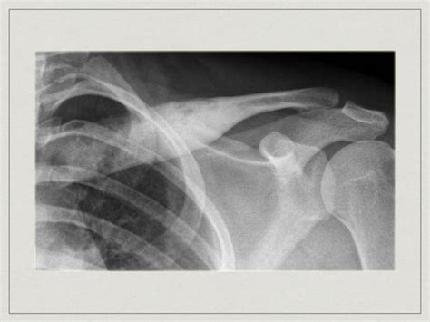 Chest Wall Tumor Pdf Lung And Respiratory Health Diseases And Conditions