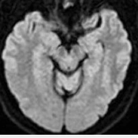 Magnetic Resonance Diffusion Weighted Imaging Dwi Showing A Punctate Download Scientific