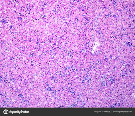 Liver Erythroblastosis Fetalis Characterized Intravascular Proliferation Immature Precursors