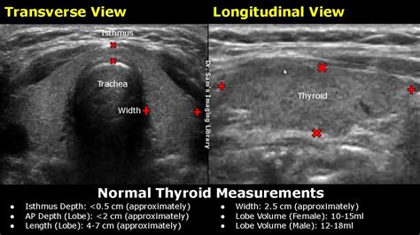 how to measure thyroid on ultrasound length width ap depth and volume