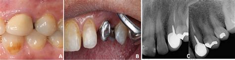 Orthodontic Extrusion For Restorability In Maxillary Teeth Imcrj