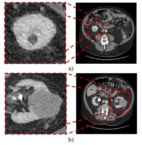 An Example Of A Benign Renal Cyst B Solid Renal Mass On Cect Images