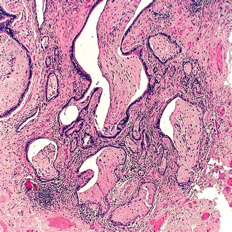 Chronic Diffuse Lung Diseases Clinical Tree