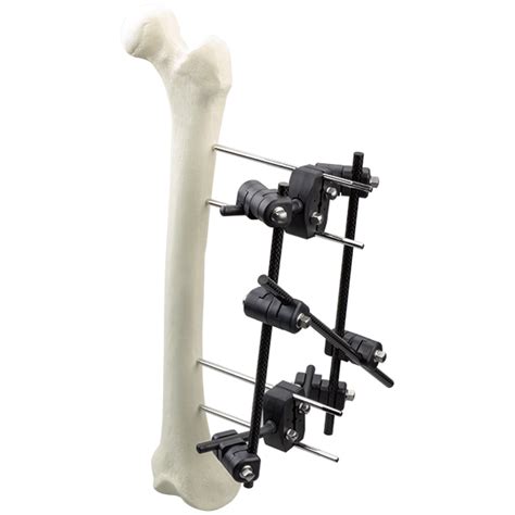 China Φ80 Series External Fixation Fixator Femoral Unilateral Reinforcement Frame Factory And