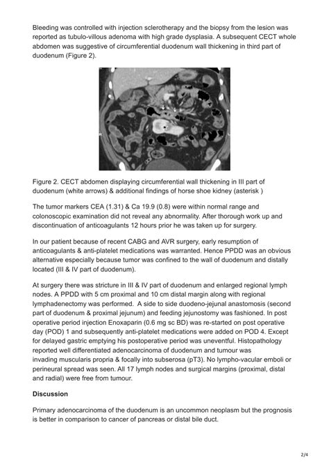 Ppt Cancer Of Distal Duodenum Whipples Procedure Or Pancreas Preserving Distal Duod Powerpoint