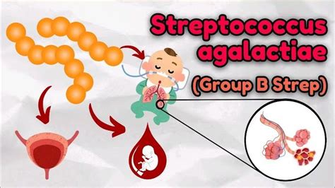 Streptococcus Agalactiae A Comprehensive Guide Streptococcus
