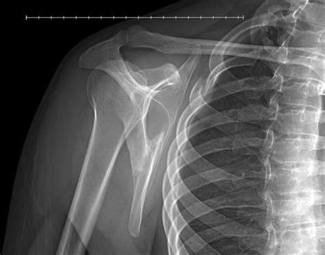 Xray Shoulder Scapula Y View Diagram Quizlet