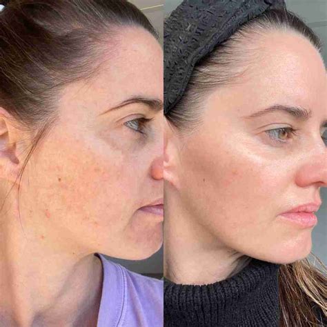 Melasma Before And After Images Australian Made Skincare