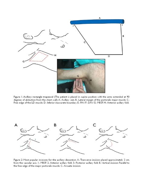 Surgical Anatomy And Operative Technique Of The Axillary Lymph Node