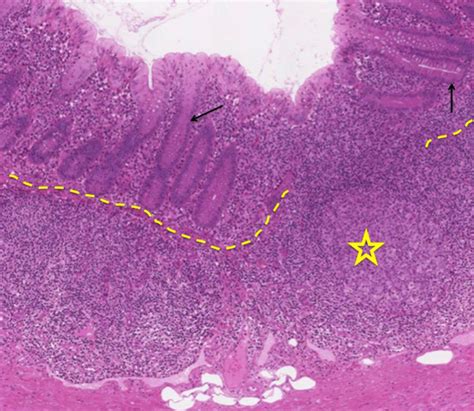 Lymphatic Tissue Uwsom Wwami Histopathology Thread Lymphatic Tissue Uwsom Wwami Histopathology Thread