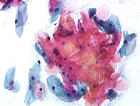 Cytopathology Of The Uterine Cervix Digital Atlas