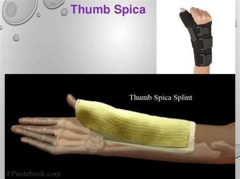Ortho Glass Splinting Chart A Visual Reference Of Charts Chart Master